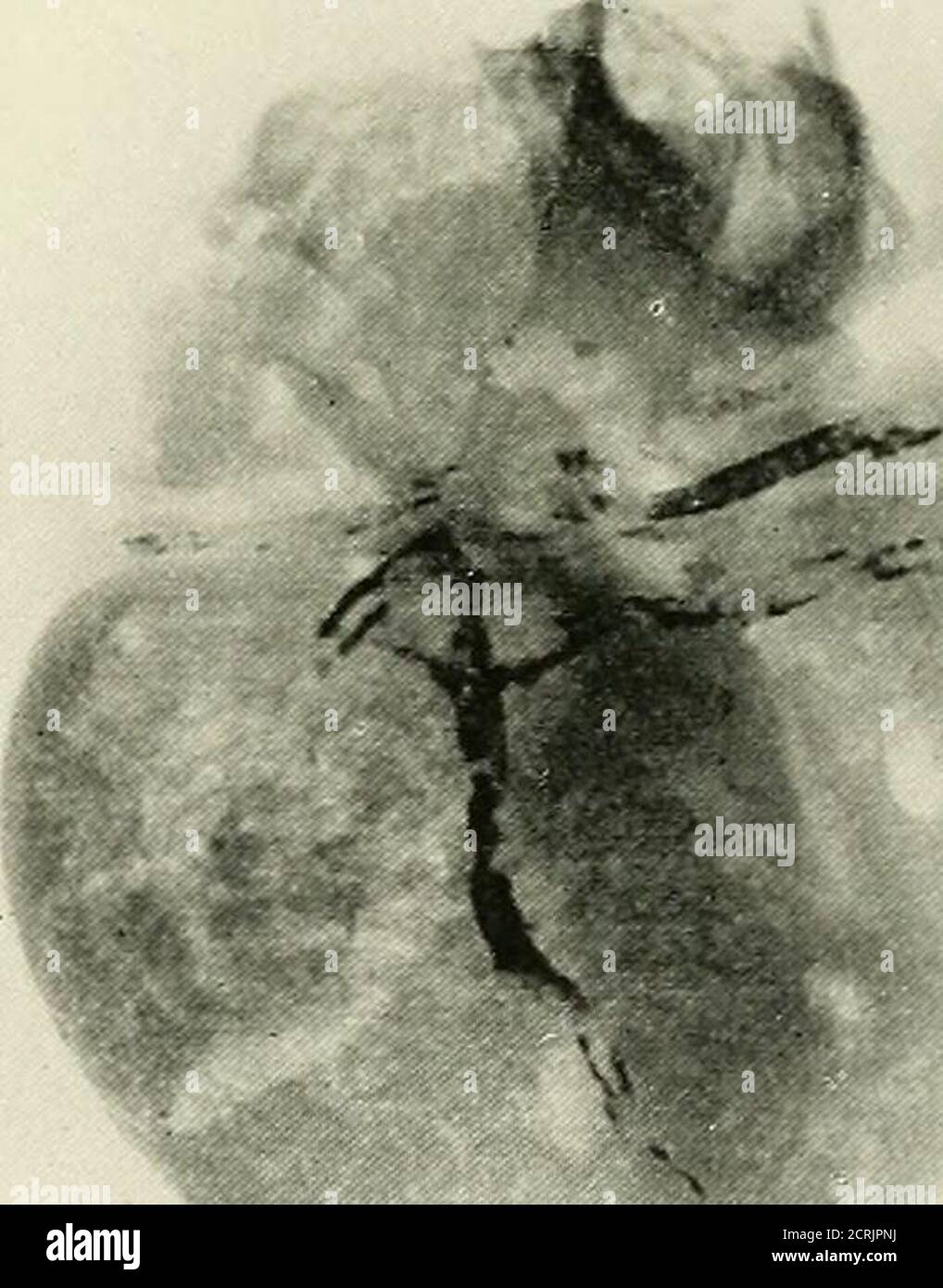 . Radiografia, radioterapia e radioterapia . LIU. PIASTRA: Cisti ...