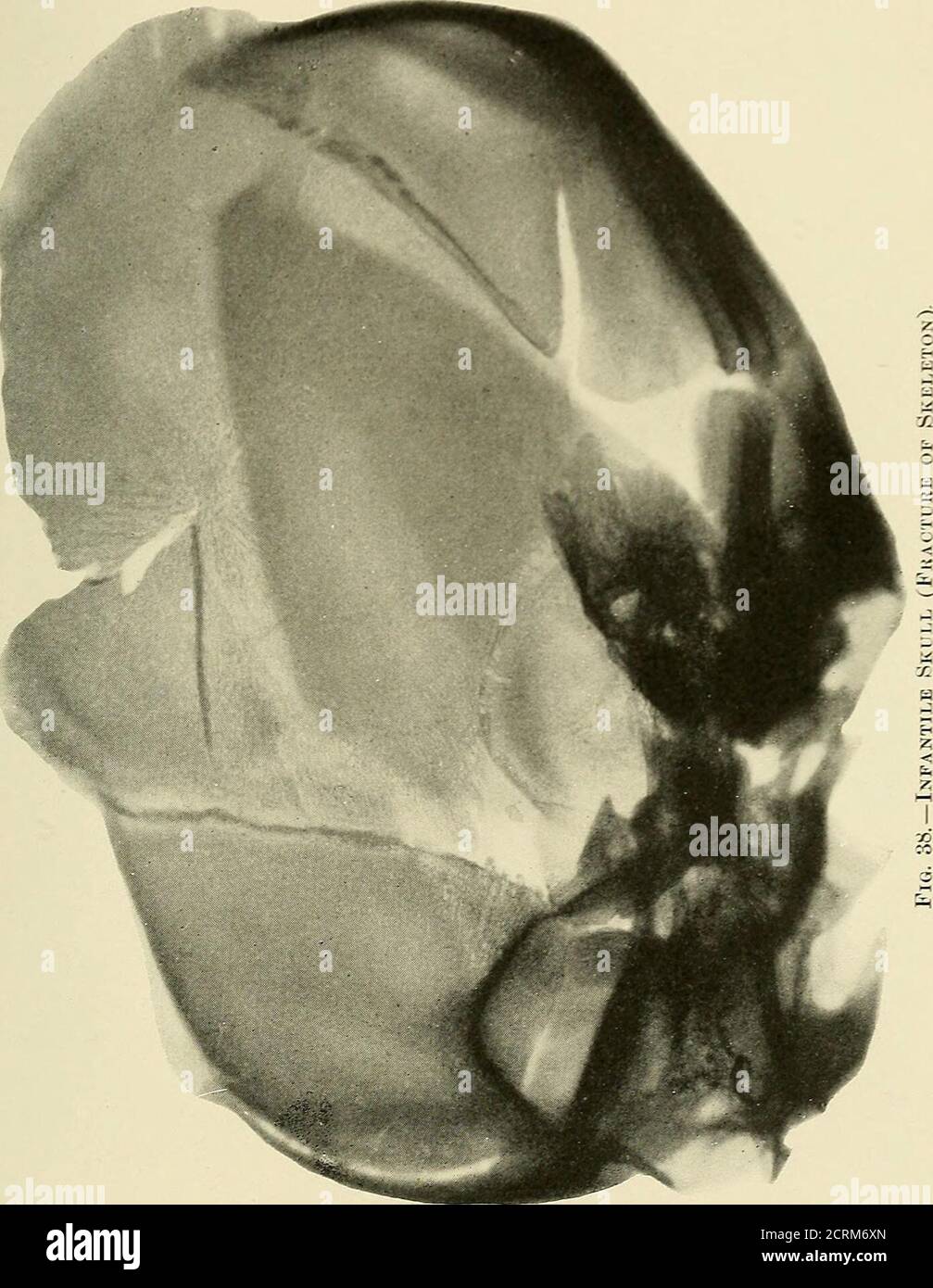 Protuberanza occipitale esterna immagini e fotografie stock ad alta ...