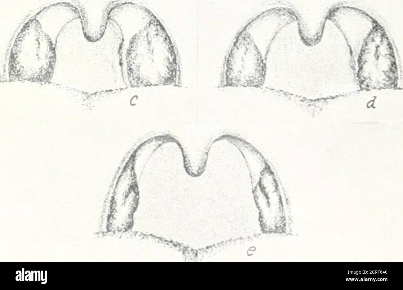 Tonsille normali immagini e fotografie stock ad alta risoluzione - Alamy