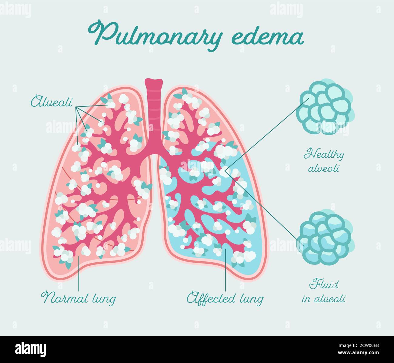 Alveoli polmonari disegno Immagini Vettoriali Stock - Alamy