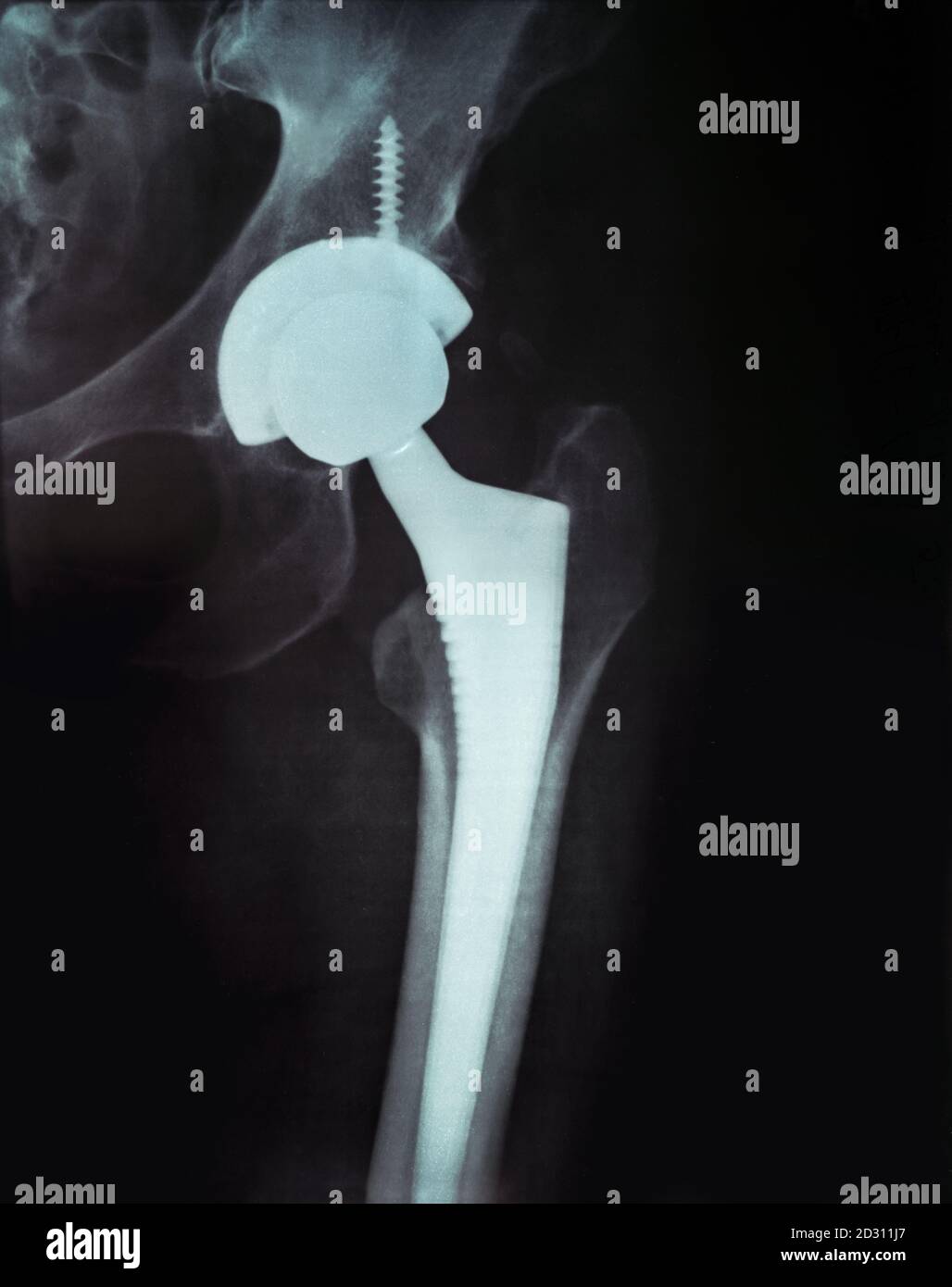 Radiografia dell'endoprotesi pelvica, della presa dell'articolazione ...