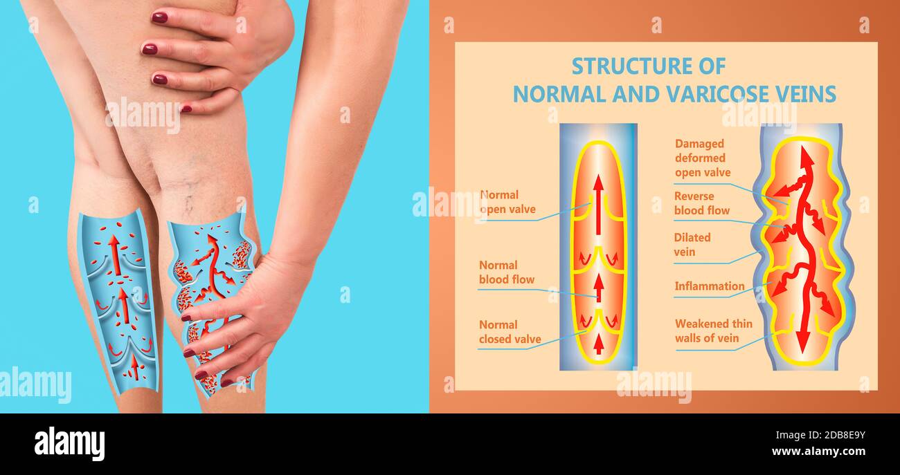 Vena varicosa su una gamba femminile senior. La struttura delle vene ...