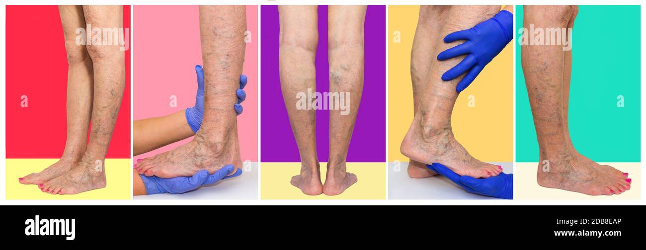 La femmina gambe con le vene varicose a ragno studio. Collage. Arto ...