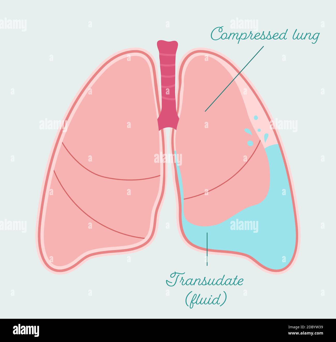 Idrotorace - schema anatomico in stile disegnato a mano. Accumulo di ...