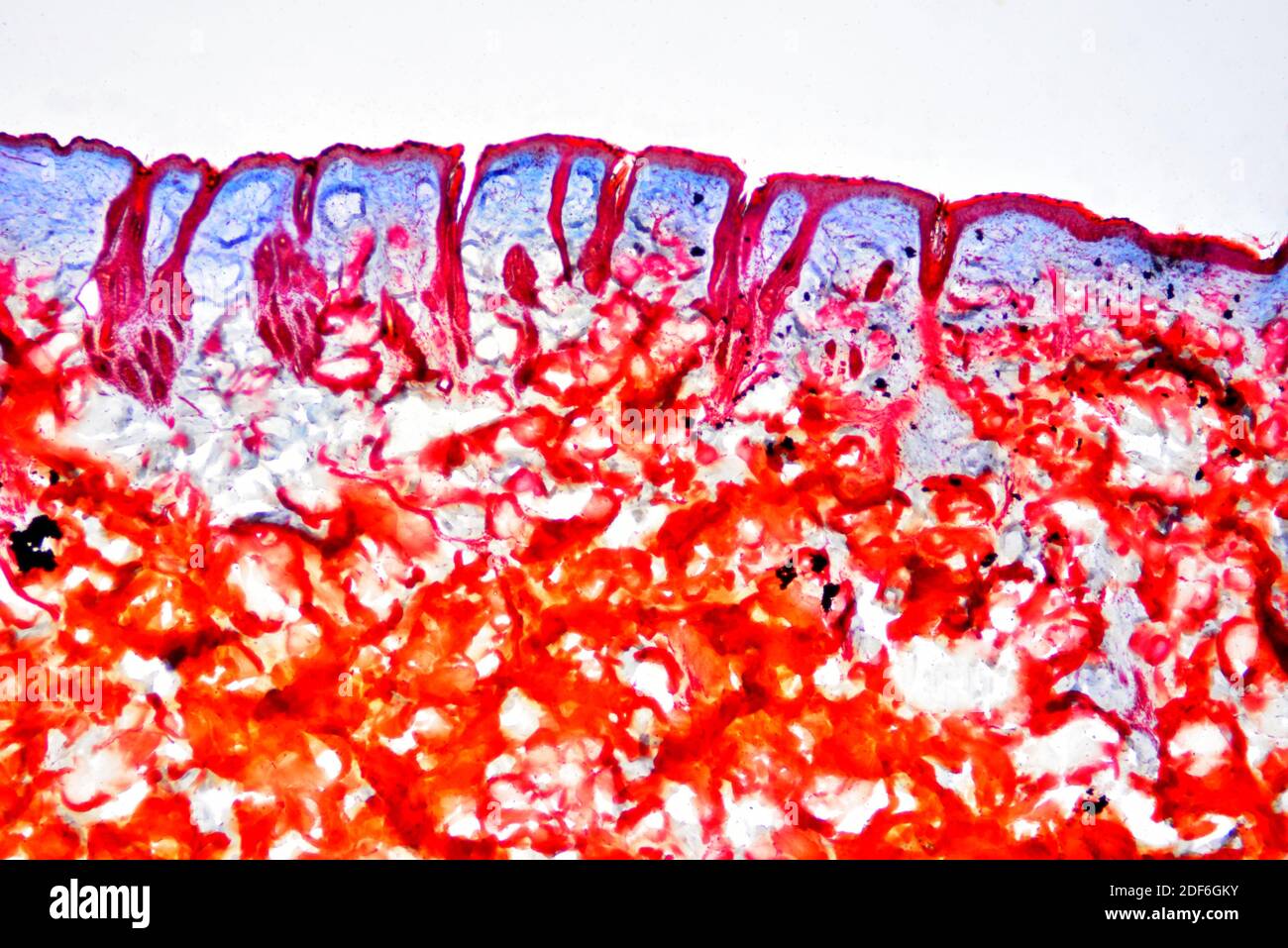 Scabies and mite or mites immagini e fotografie stock ad alta ...