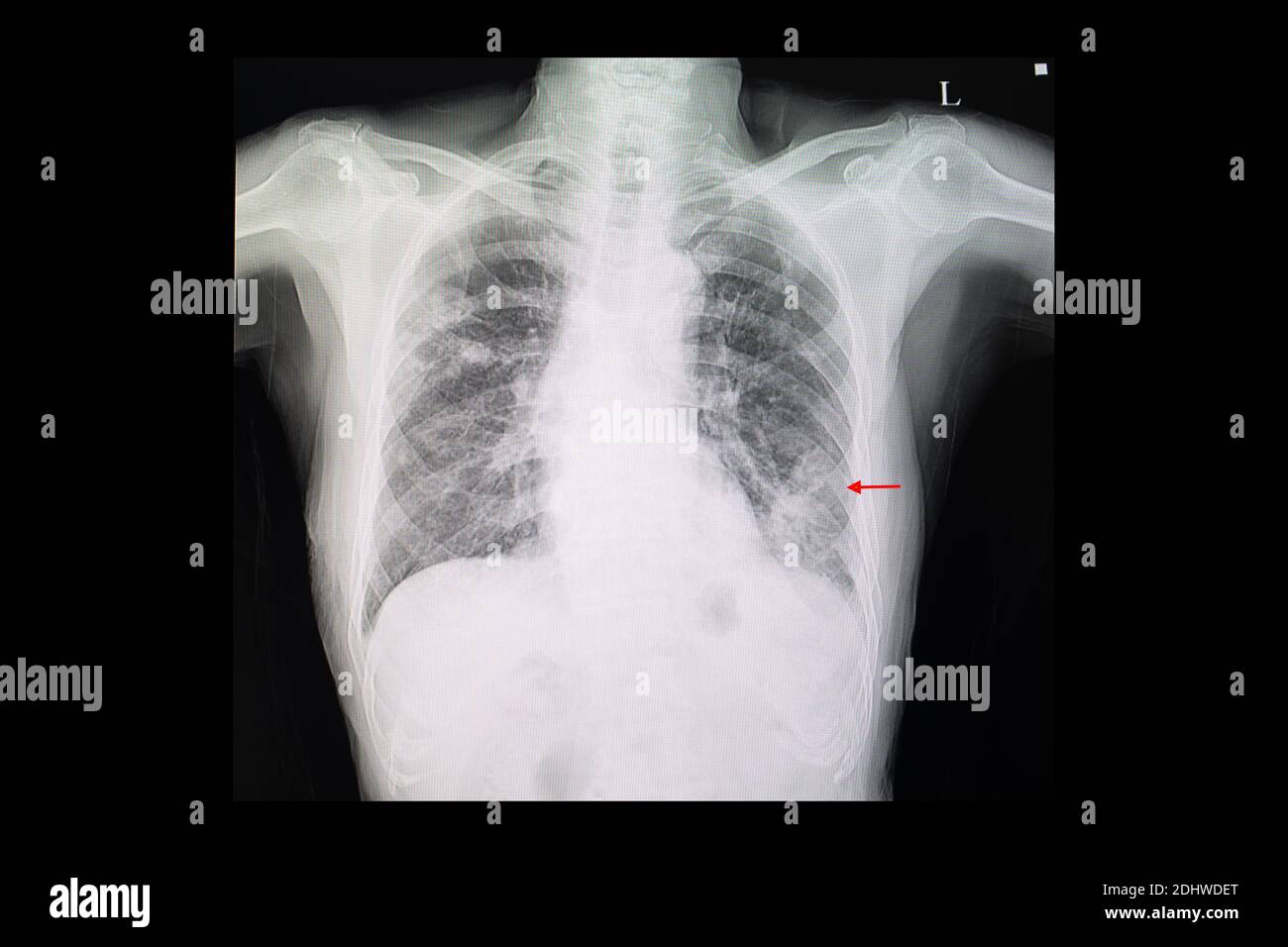 Noduli polmonari immagini e fotografie stock ad alta risoluzione - Alamy