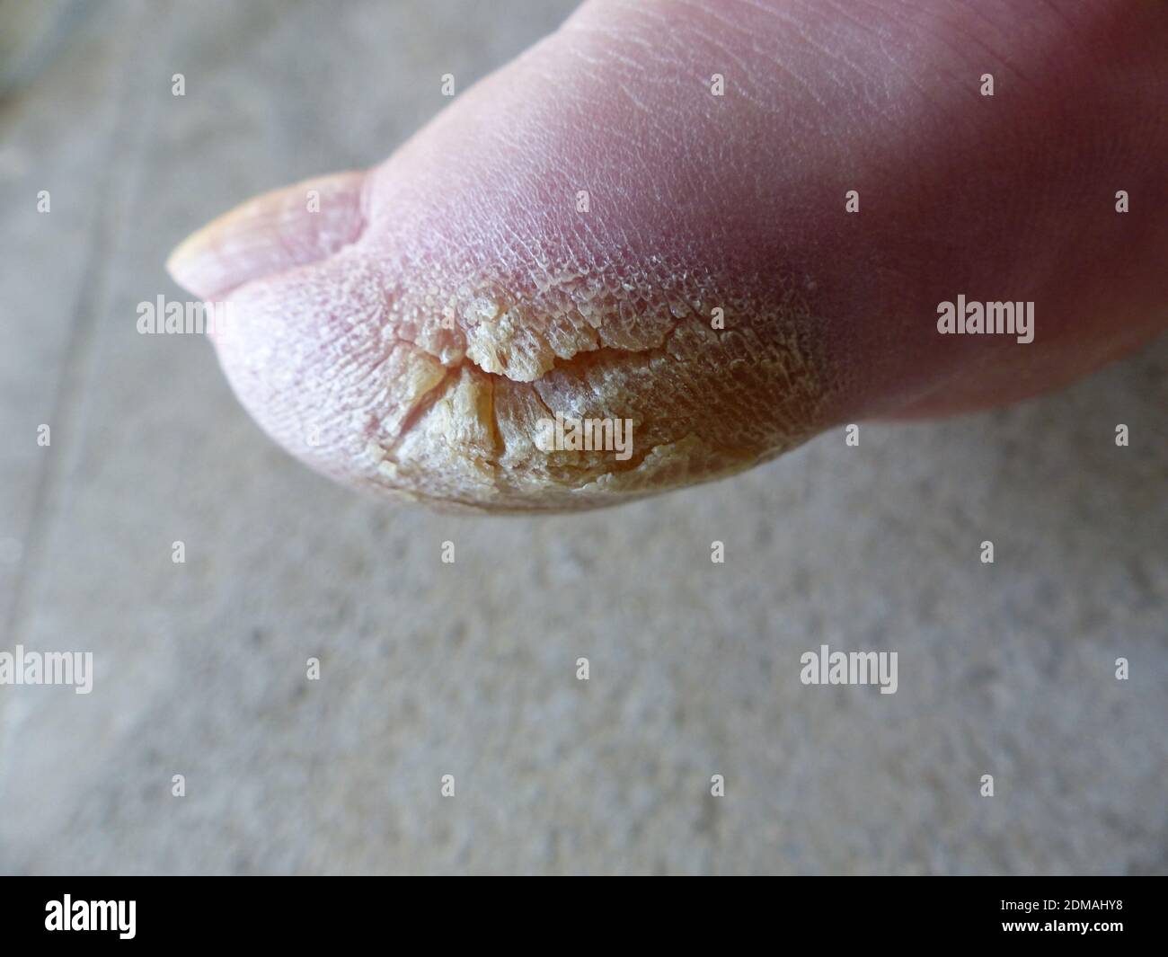 Callo piede immagini e fotografie stock ad alta risoluzione - Alamy