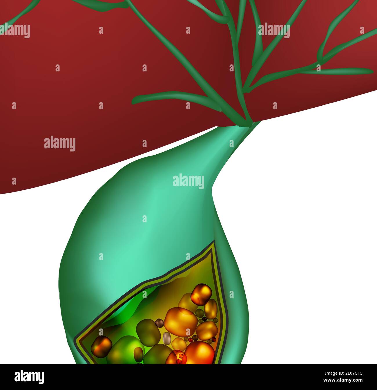 Calcoli biliari. Colelitiasi. Colecistite. Infiammazione della ...