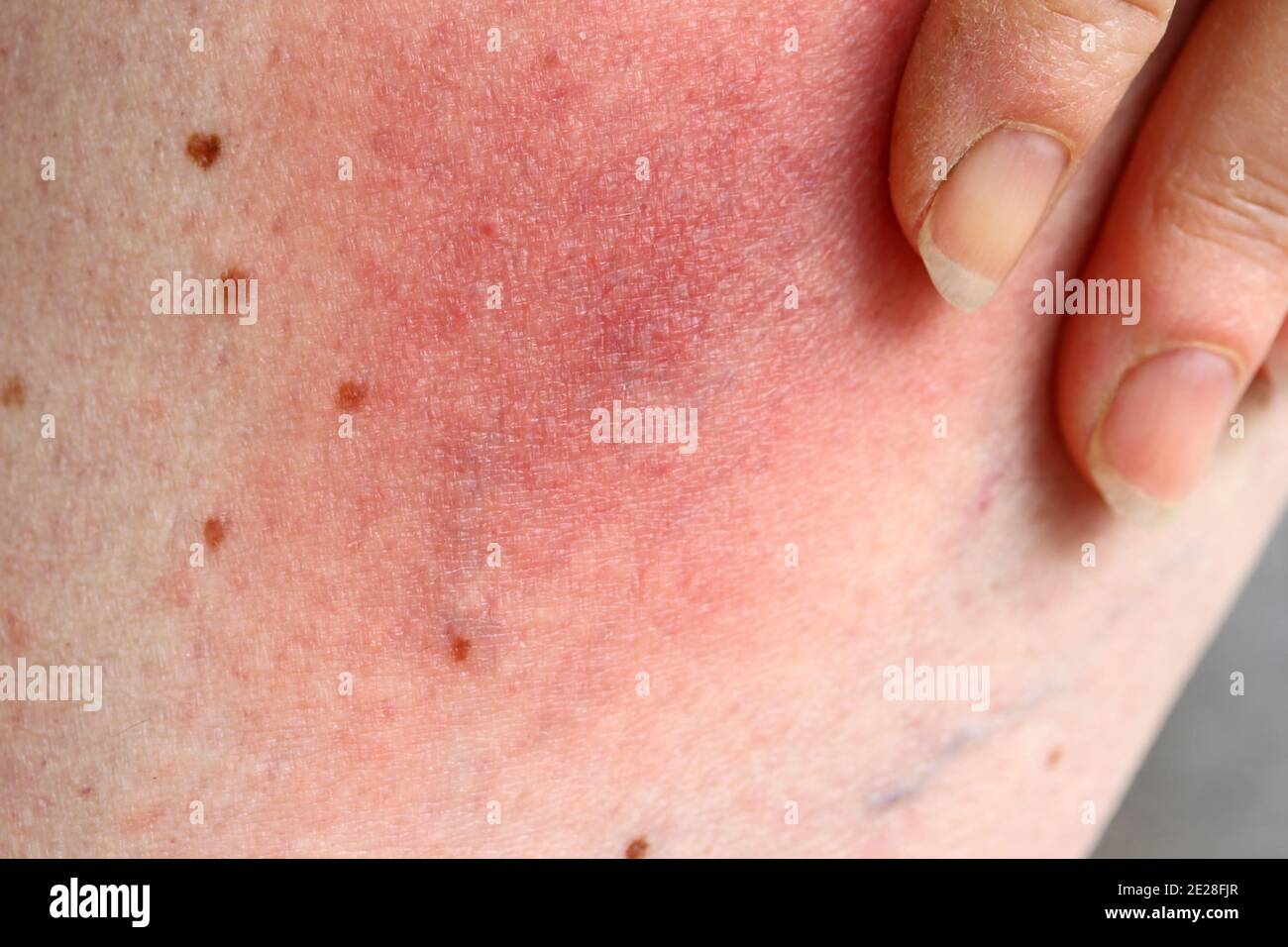 Morso di zecca sintomi immagini e fotografie stock ad alta risoluzione ...