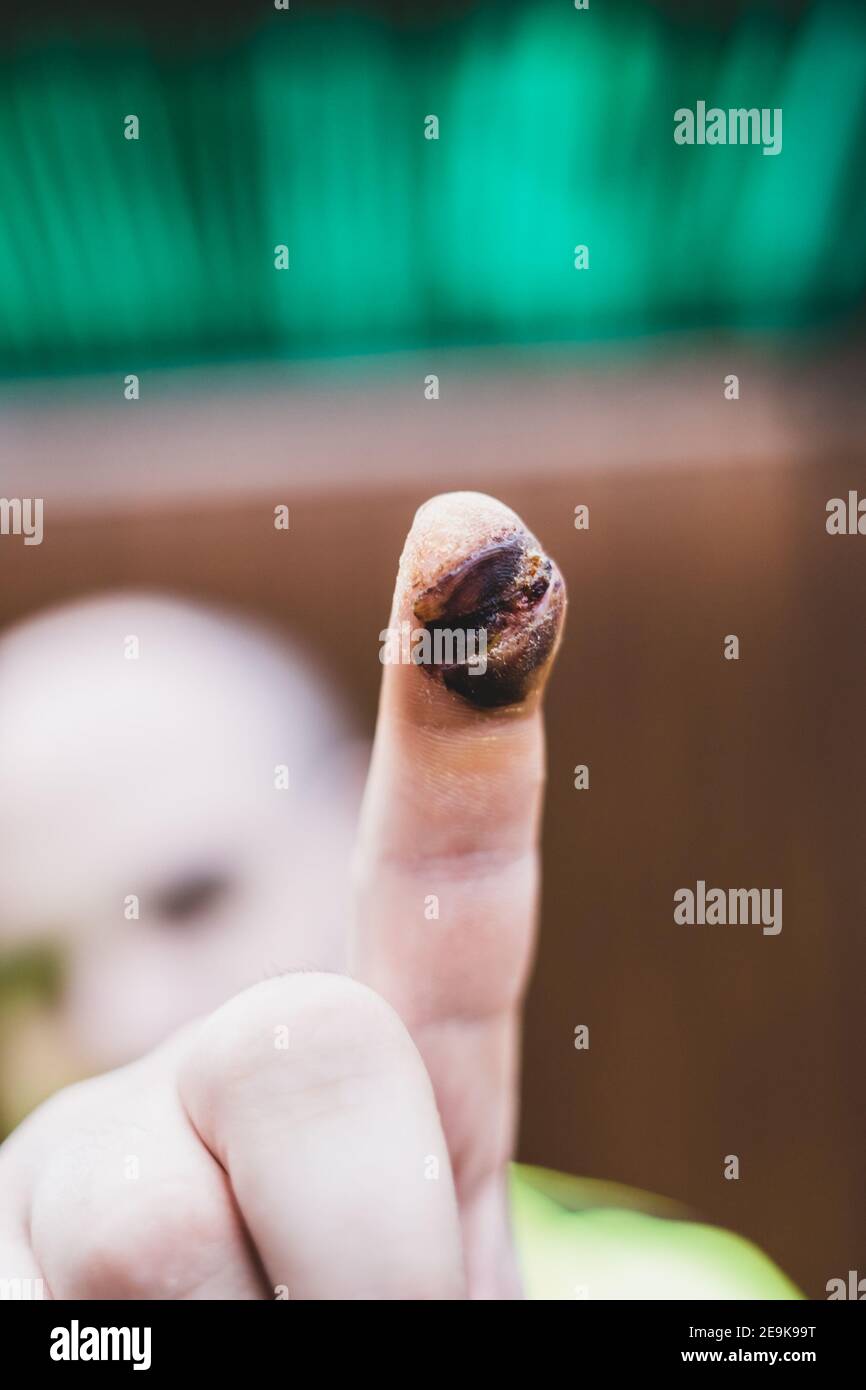 Dito rotto immagini e fotografie stock ad alta risoluzione - Alamy