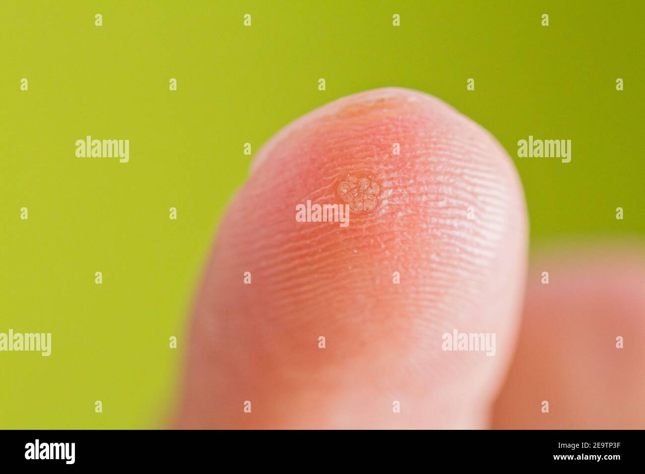 Verruca macro immagini e fotografie stock ad alta risoluzione - Alamy