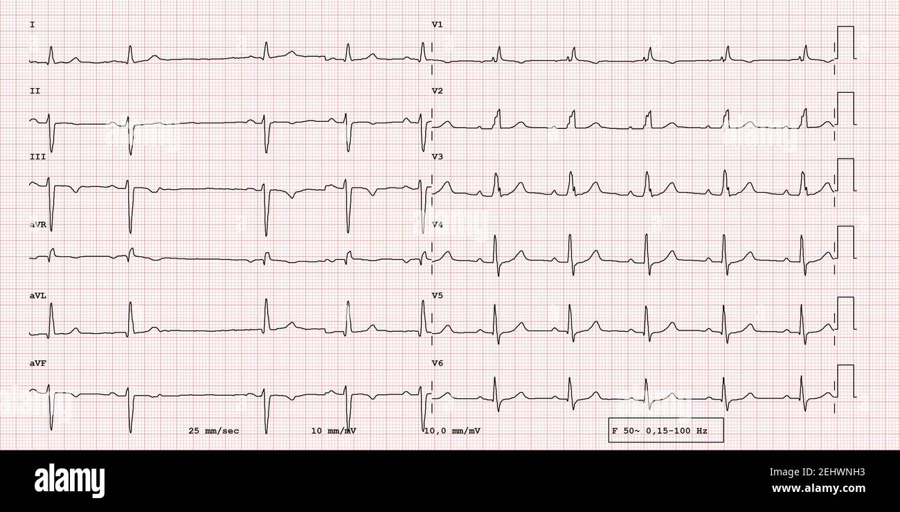 Esempio ECG di ritmo patologico a 12 derivazioni, fibrillazione atriale ...