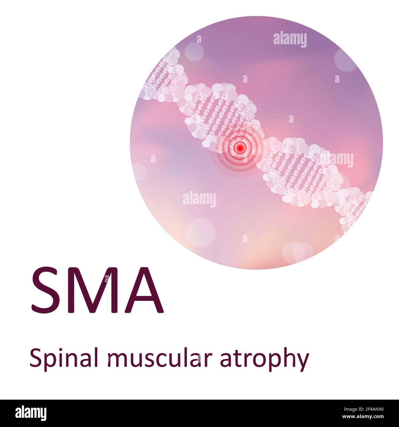 Malattia da atrofia muscolare immagini e fotografie stock ad alta ...