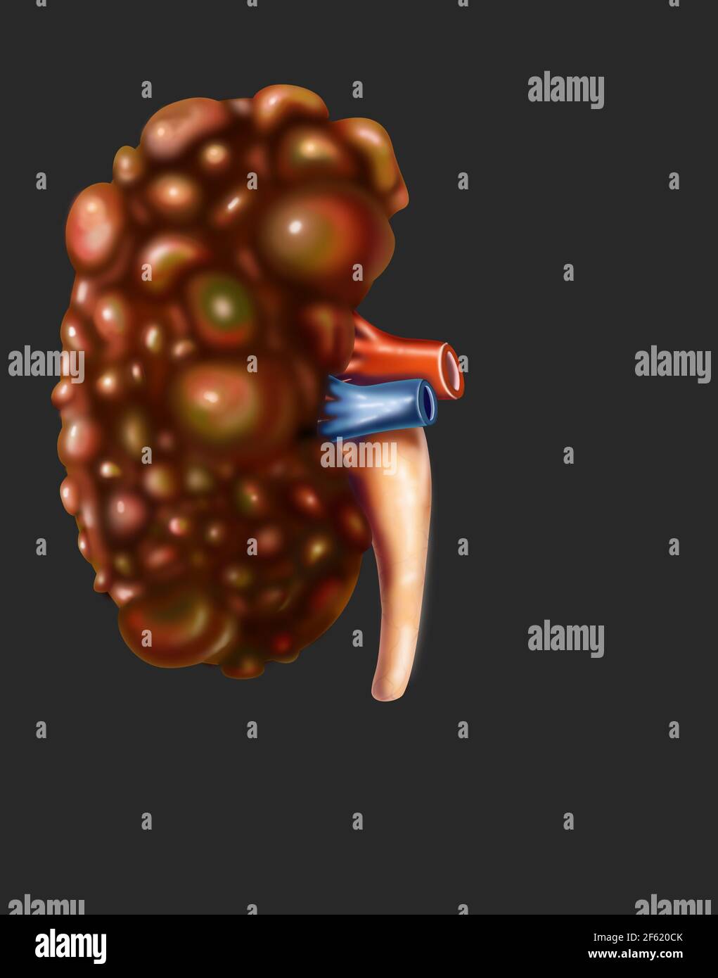 Malattia policistica immagini e fotografie stock ad alta risoluzione ...