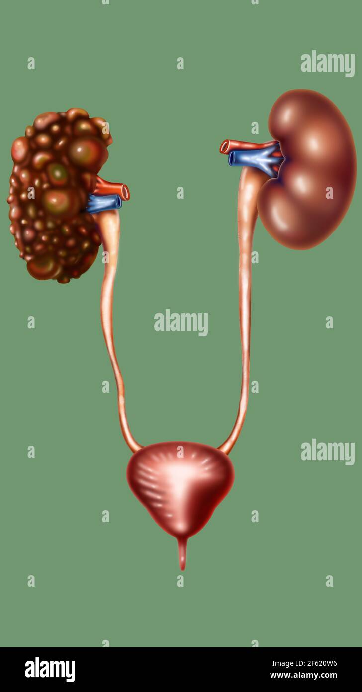 Rene policistico immagini e fotografie stock ad alta risoluzione - Alamy