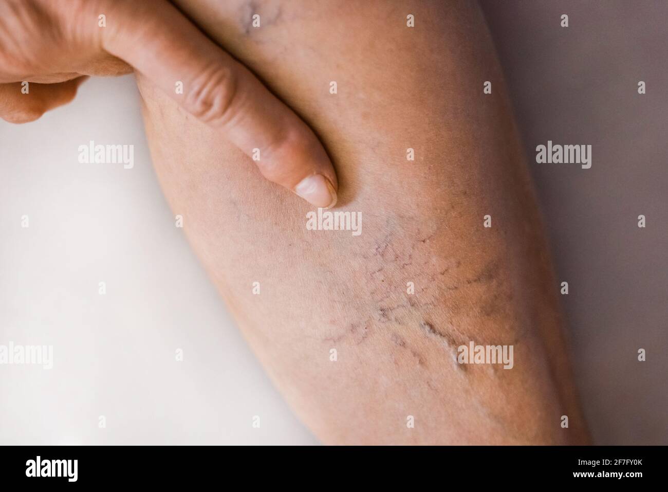 Trombosi delle vene delle gambe immagini e fotografie stock ad alta ...