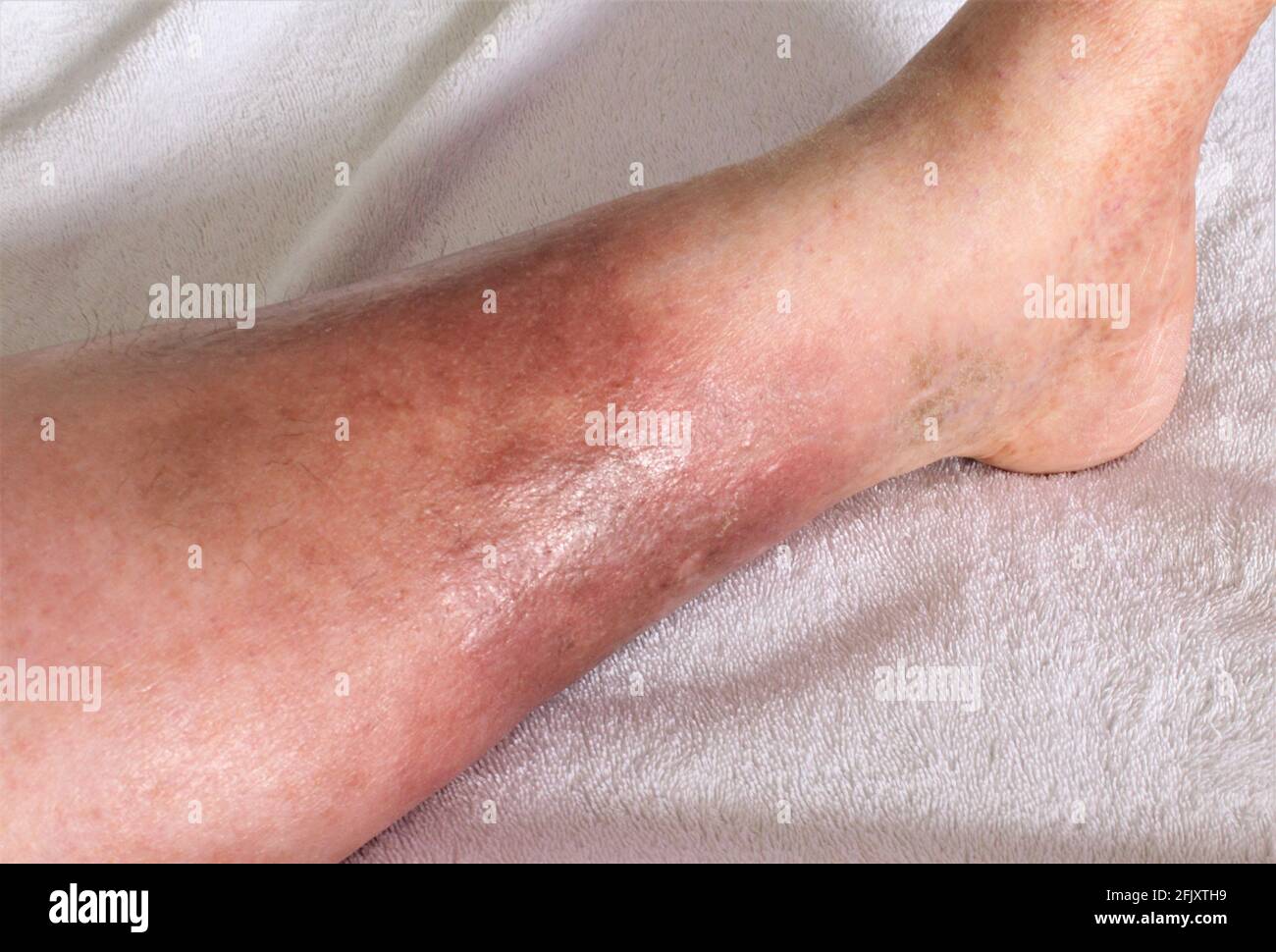 Swelling leg immagini e fotografie stock ad alta risoluzione - Alamy