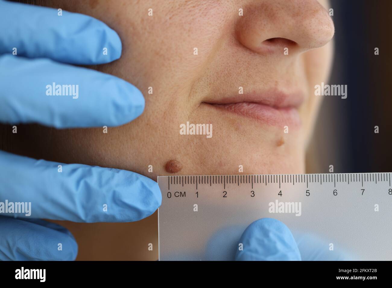 Wart removal immagini e fotografie stock ad alta risoluzione - Alamy