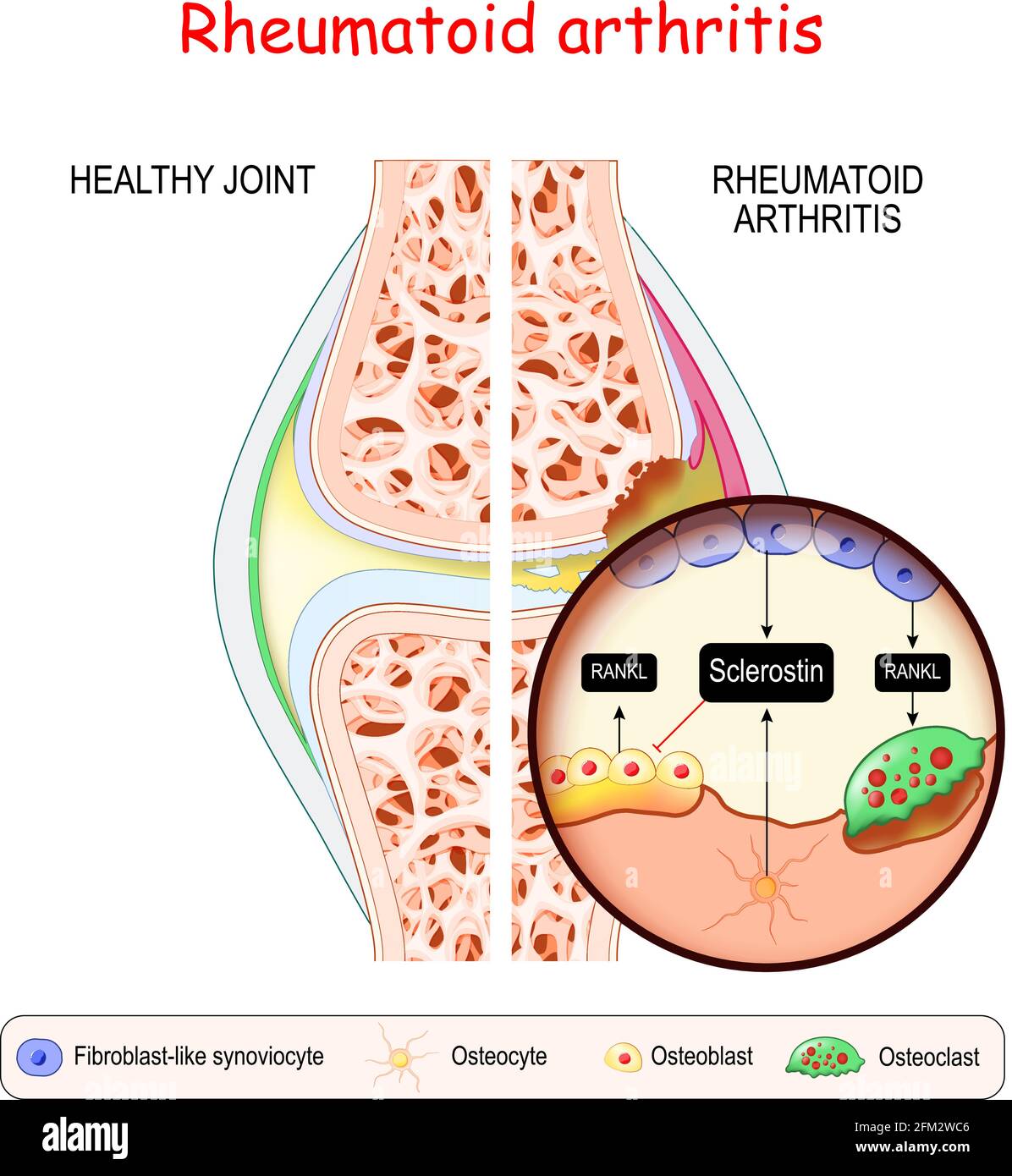 Cellula osteoclasta Immagini Vettoriali Stock - Alamy