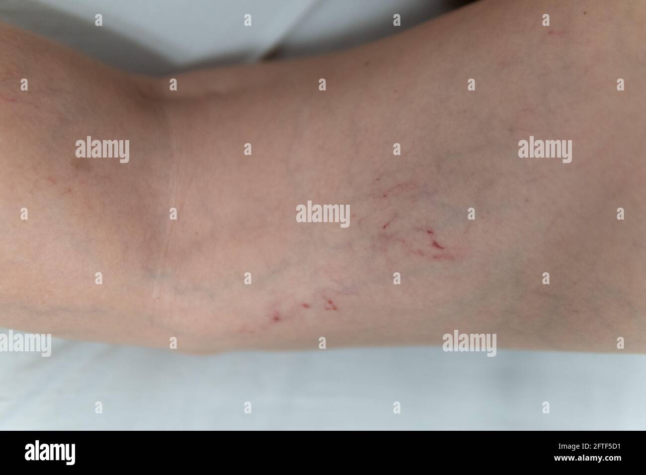 Rimozione del gonfiore immagini e fotografie stock ad alta risoluzione ...