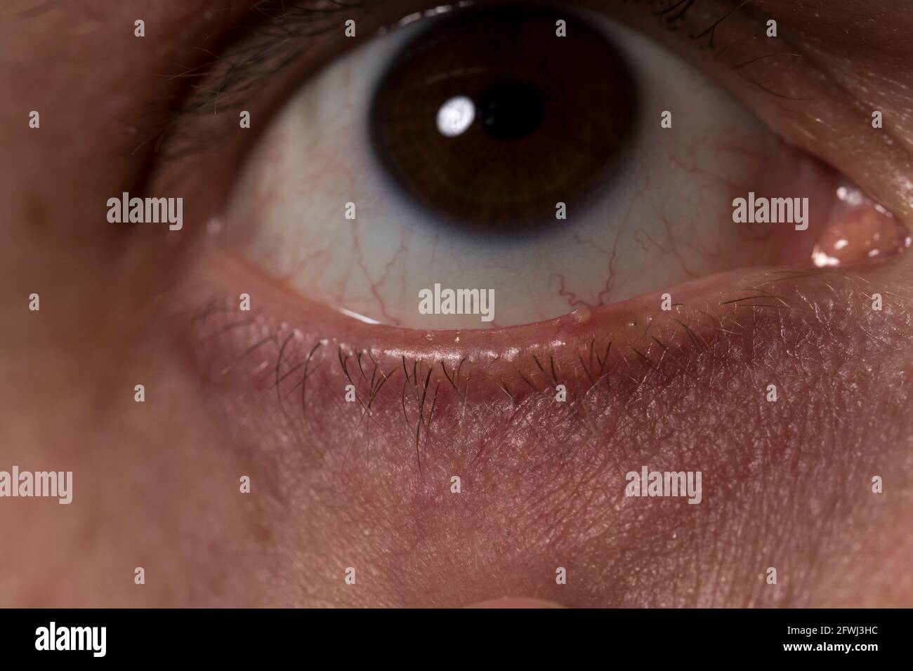 Cisti dolorose immagini e fotografie stock ad alta risoluzione - Alamy