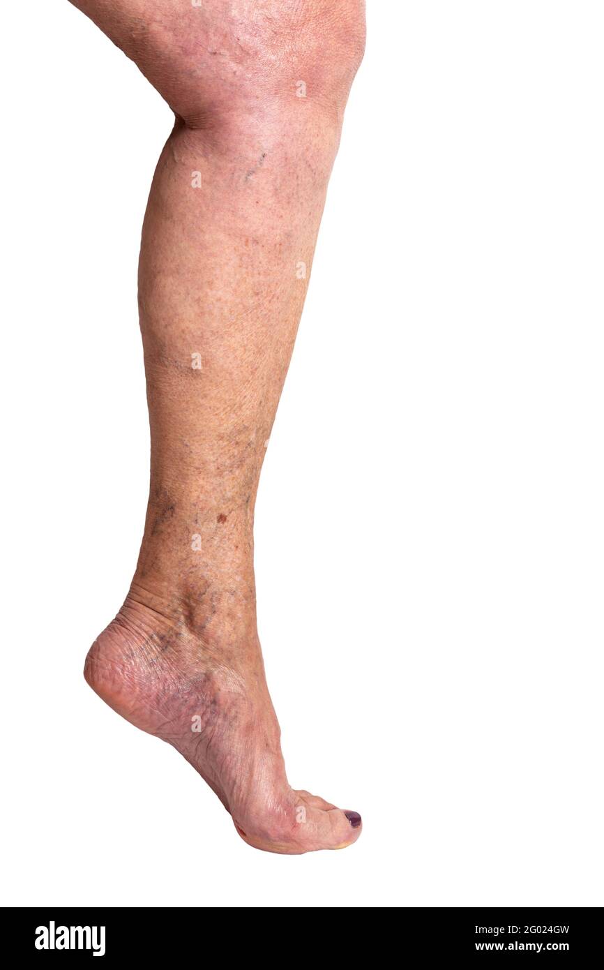 Trombosi delle vene delle gambe immagini e fotografie stock ad alta ...