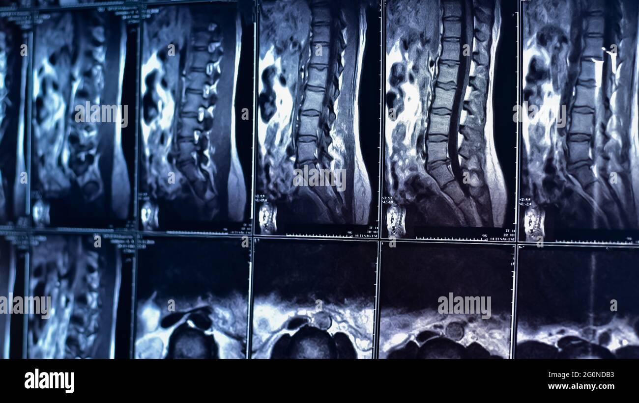 Mri di colonna lombare immagini e fotografie stock ad alta risoluzione ...