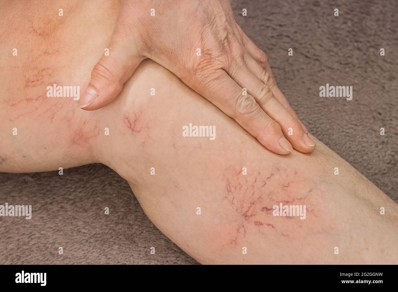 Trombosi delle vene delle gambe immagini e fotografie stock ad alta ...