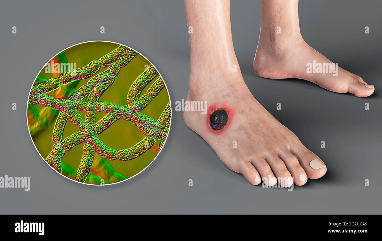 Antrace cutanea immagini e fotografie stock ad alta risoluzione - Alamy