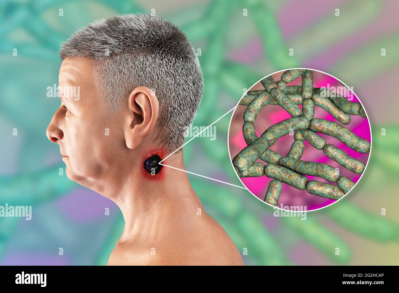 Antrace cutanea immagini e fotografie stock ad alta risoluzione - Alamy