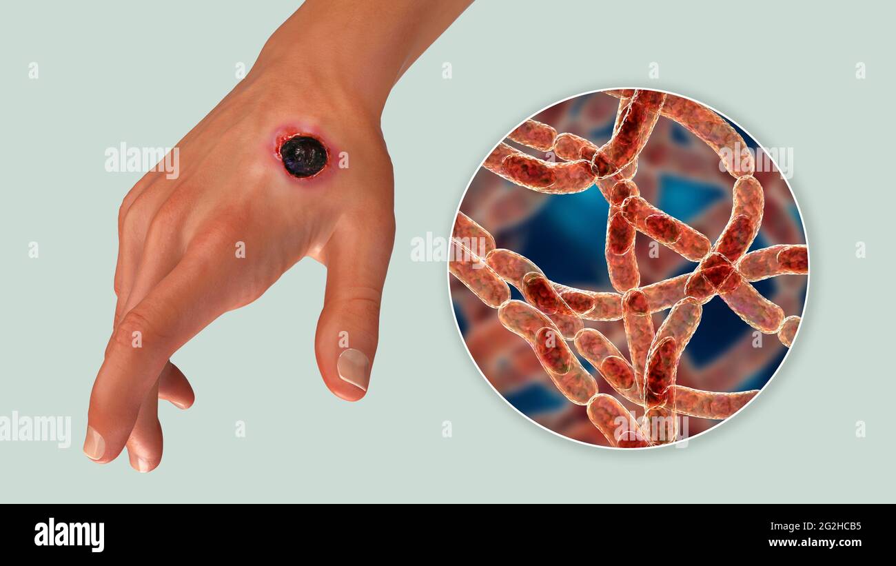 Antrace cutanea immagini e fotografie stock ad alta risoluzione - Alamy