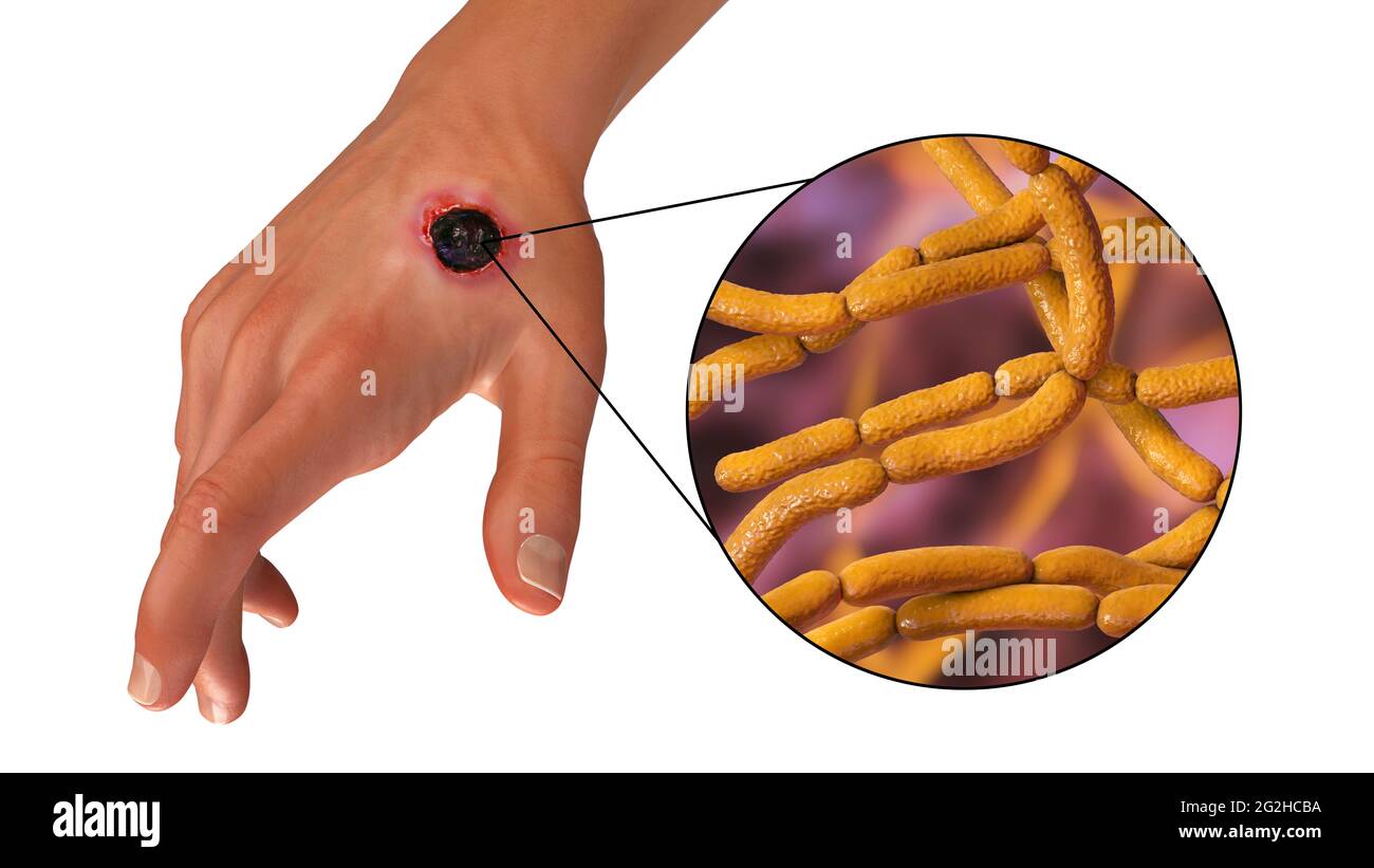 Antrace cutaneo immagini e fotografie stock ad alta risoluzione - Alamy