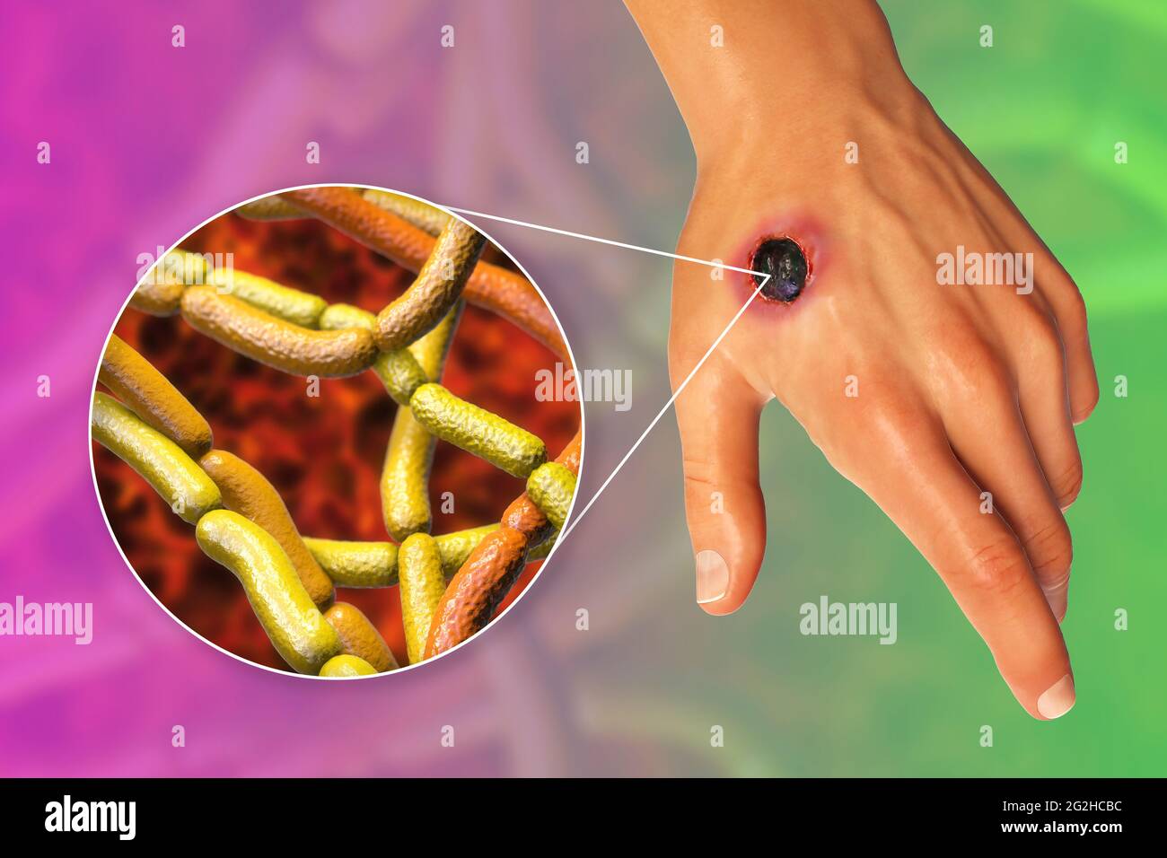 Antrace cutanea immagini e fotografie stock ad alta risoluzione - Alamy