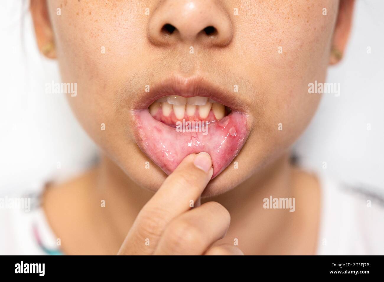Ulcera da afta immagini e fotografie stock ad alta risoluzione - Alamy