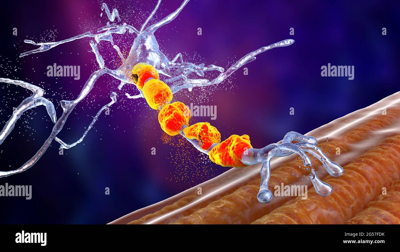 Degenerazione dei neuroni immagini e fotografie stock ad alta ...