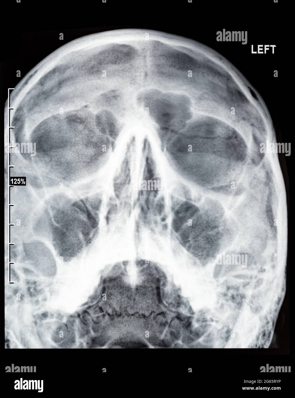 Radiografia di un cranio umano sinusale paranasale sinusite diagnostica ...