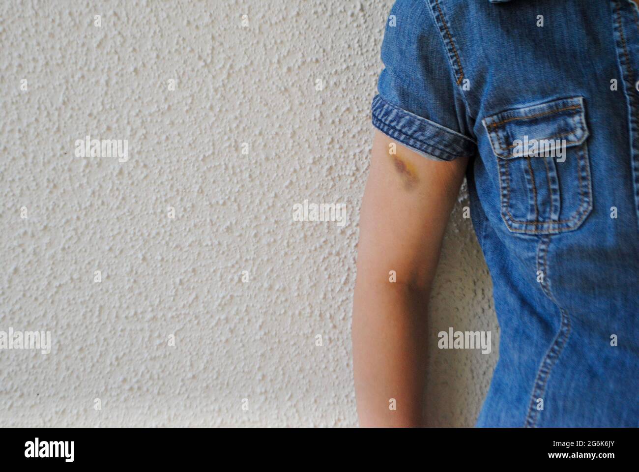 Livido viola sul braccio della donna. La lividi è un tipo di ematoma ...