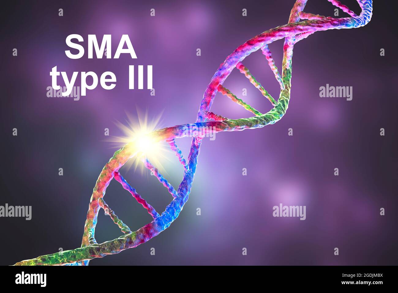 Atrofia muscolare spinale tipo iii immagini e fotografie stock ad alta ...