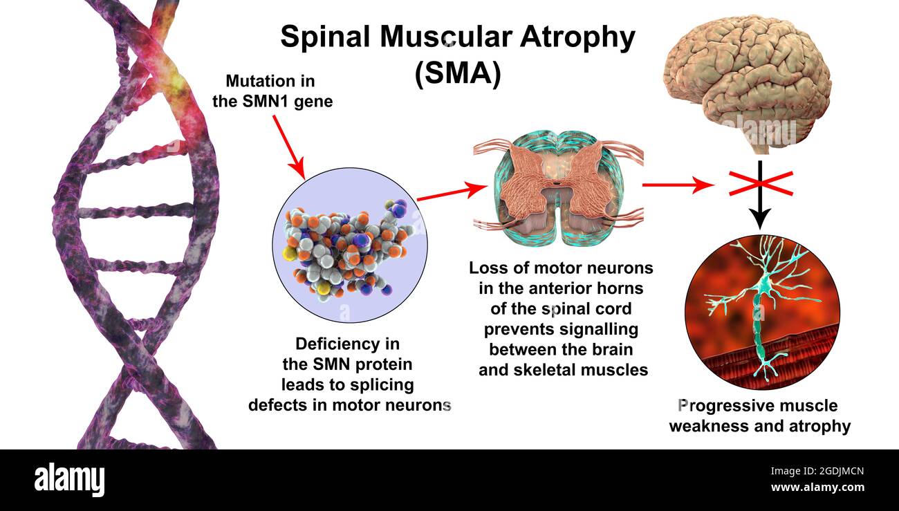 Atrofia muscolare spinale immagini e fotografie stock ad alta ...