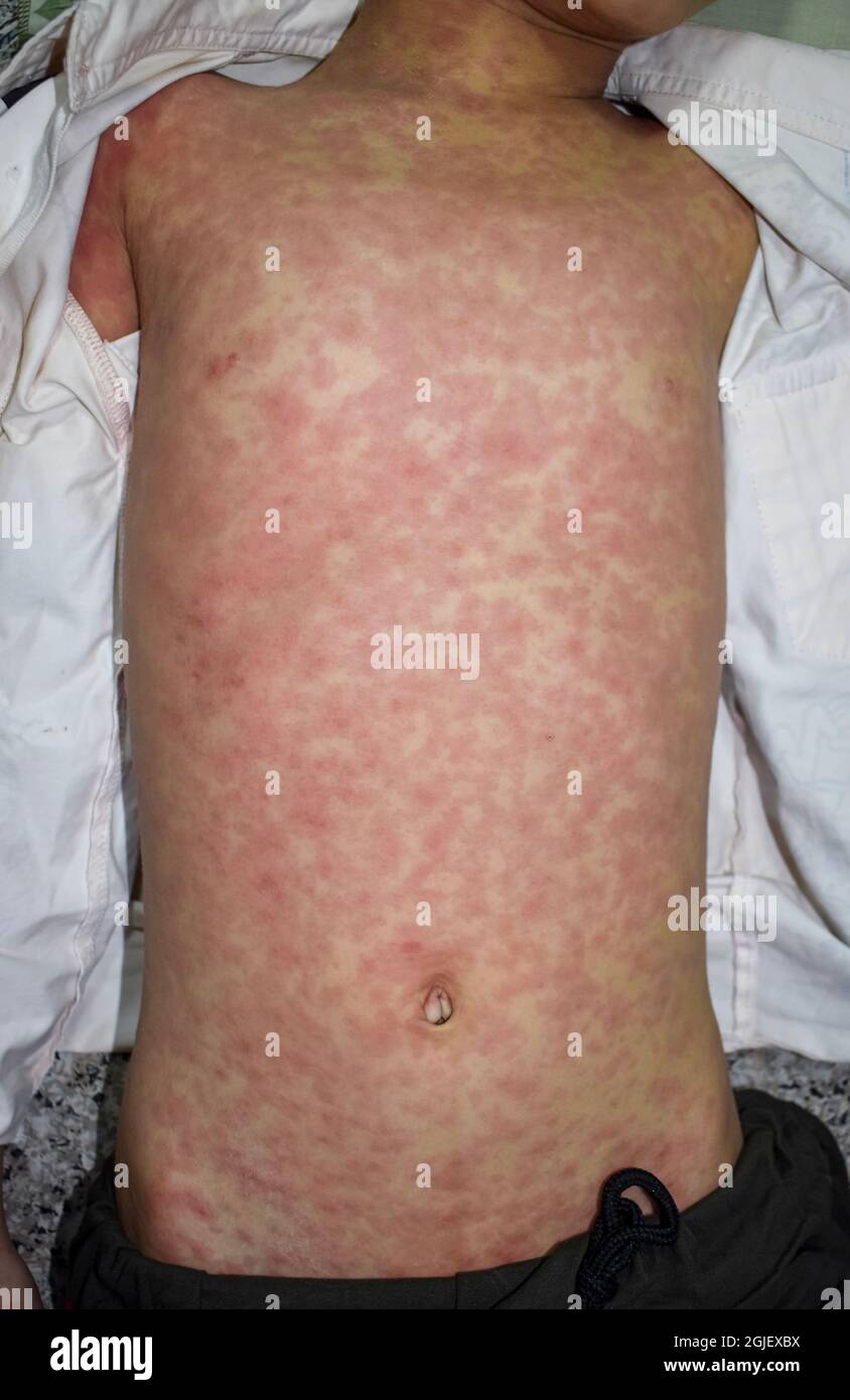 Allergy allergies rash rashes immagini e fotografie stock ad alta ...