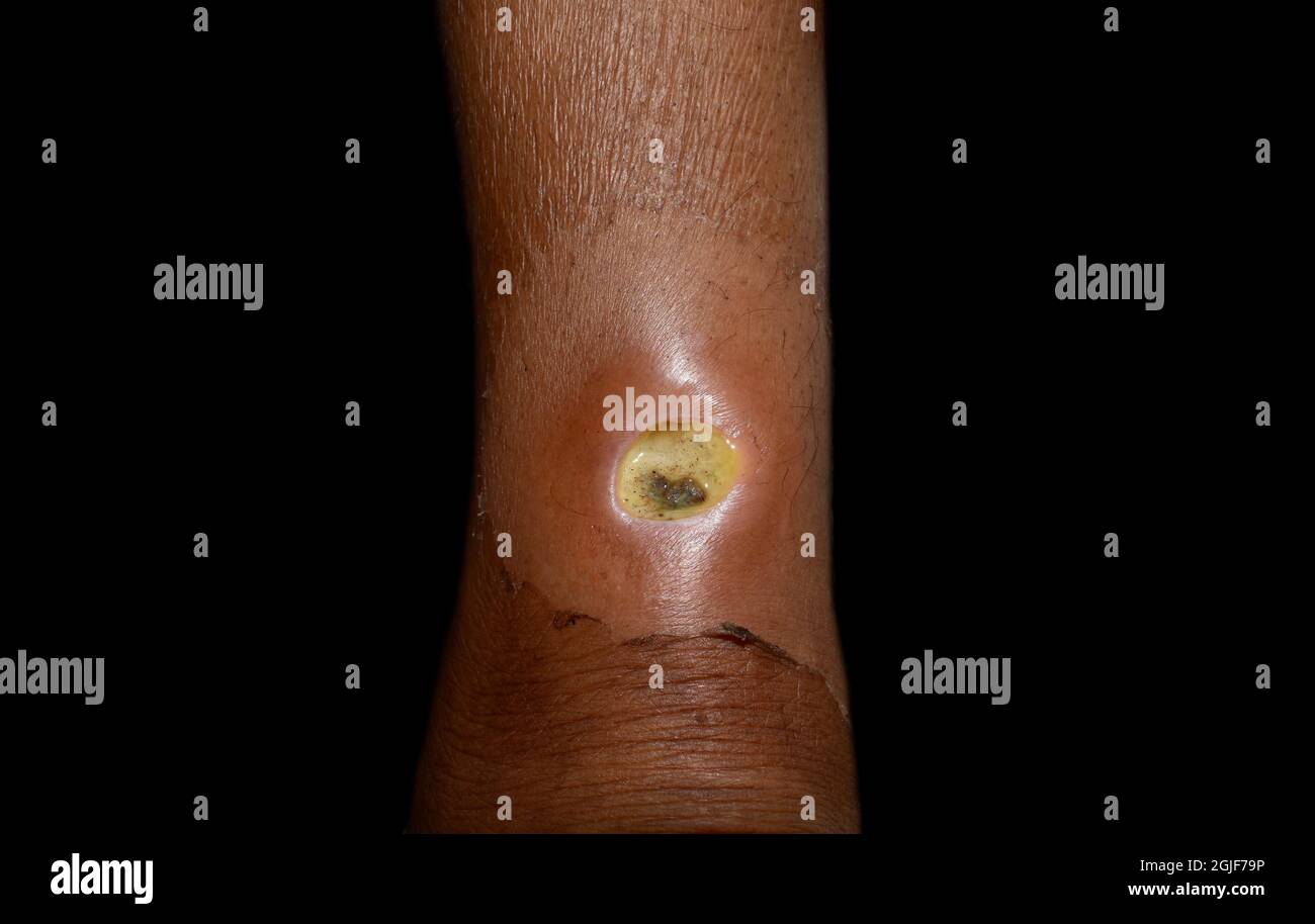 Leg ulcer immagini e fotografie stock ad alta risoluzione - Alamy