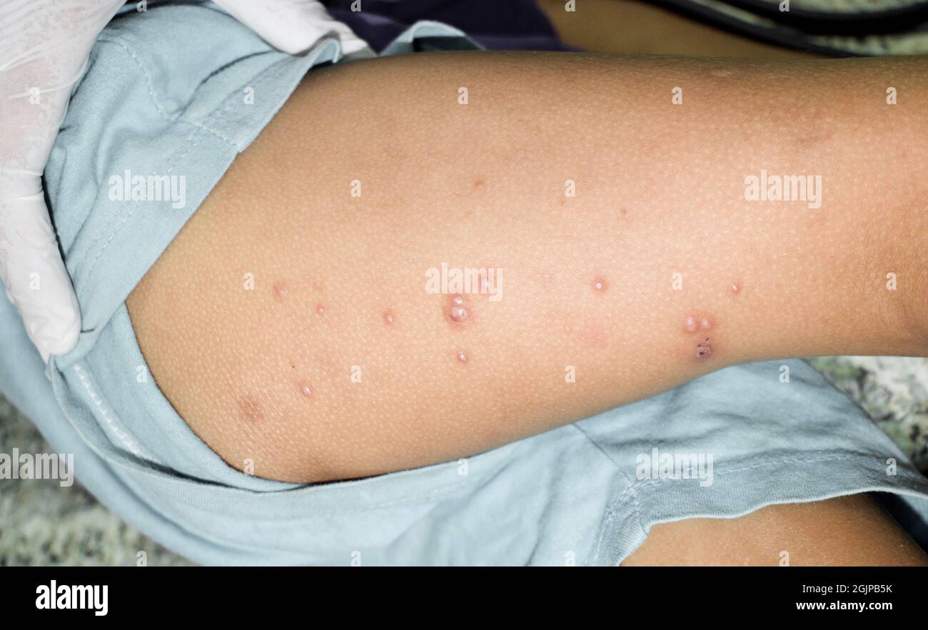 Pustole e vescicole immagini e fotografie stock ad alta risoluzione - Alamy