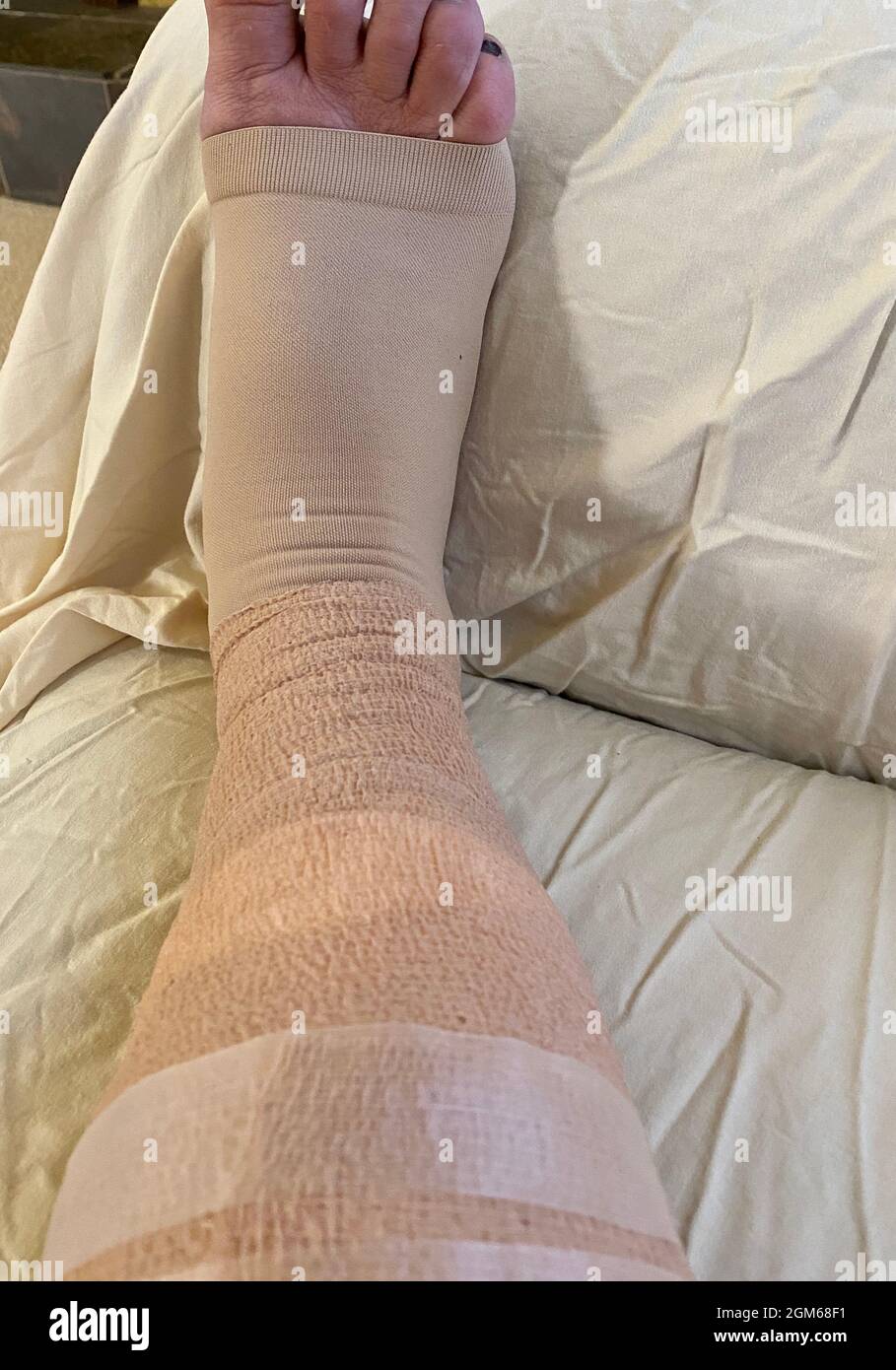 Chirurgia delle gambe immagini e fotografie stock ad alta risoluzione ...