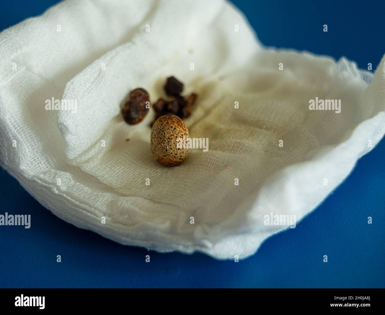 Rimozione dei calcoli biliari sulla compressione dopo la rimozione dell ...