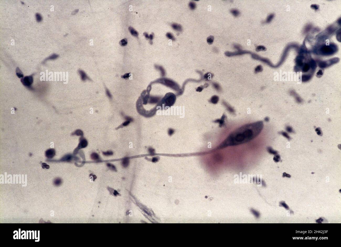 Carcinoma invasivo immagini e fotografie stock ad alta risoluzione - Alamy