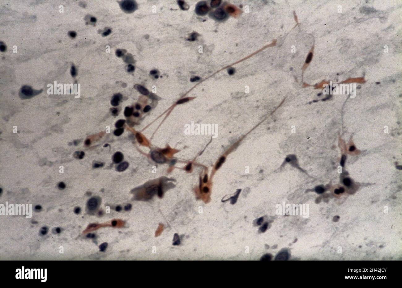 Carcinoma invasivo immagini e fotografie stock ad alta risoluzione - Alamy