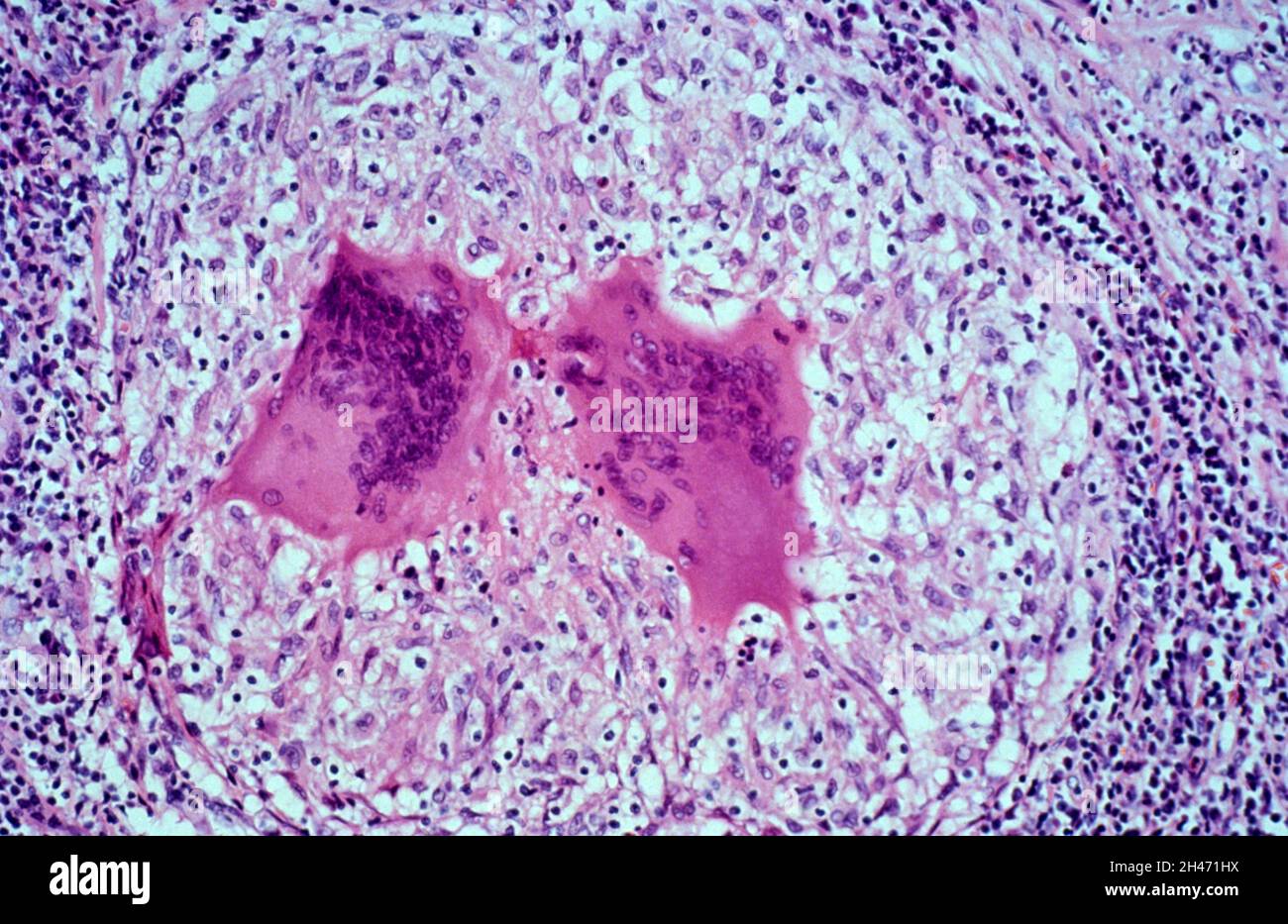 Linfoadenite tubercolare immagini e fotografie stock ad alta ...