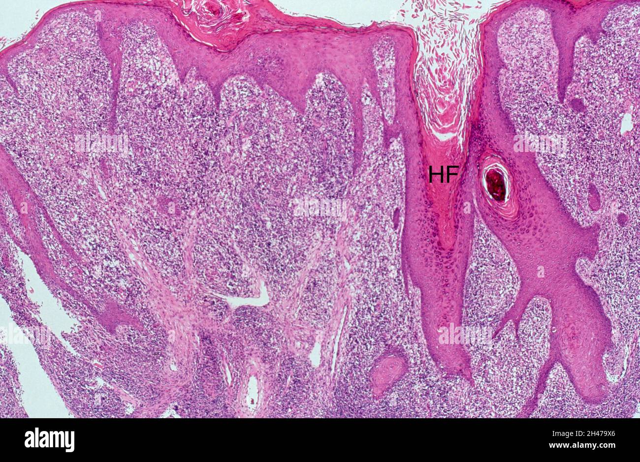 Leishmaniosi cutanea (CL): Lesione cutanea Foto stock - Alamy