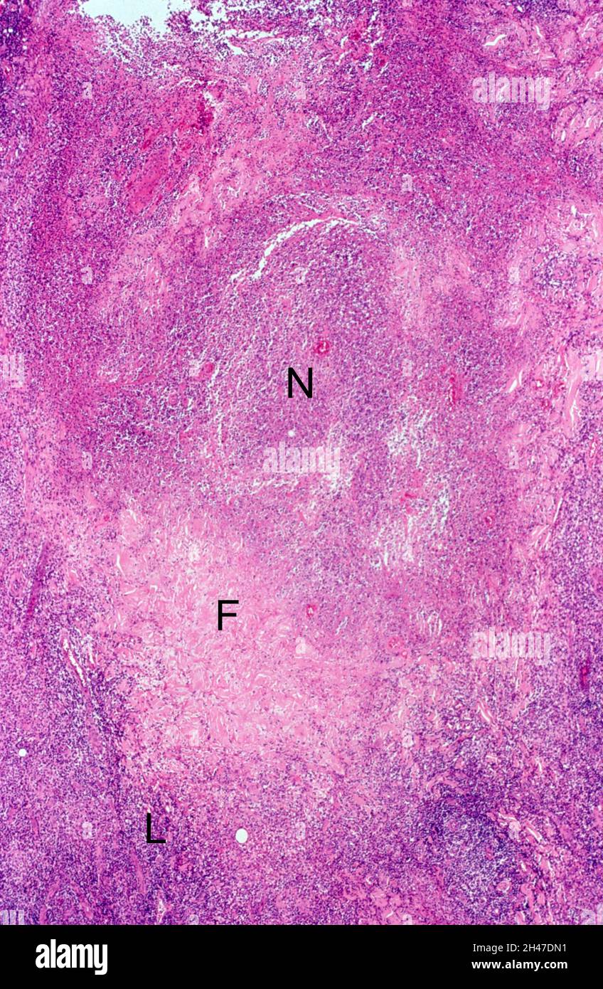 Leishmaniosi cutanea: Lesione cutanea Foto stock - Alamy