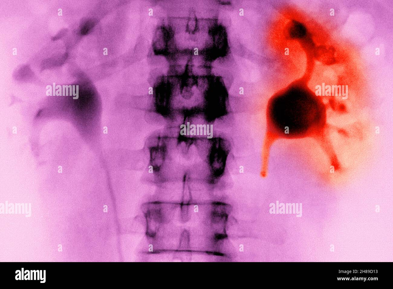Calcolo renale immagini e fotografie stock ad alta risoluzione - Alamy
